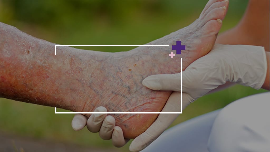 Critical Limb Ischemia Stem Cells Transplant Institute Critical Limb Ischemia Stem Cells Transplant Institute